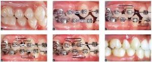 Phases of Orthodontic Treatment | Definitive Dental