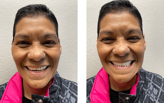 Chipped Front Tooth Woman